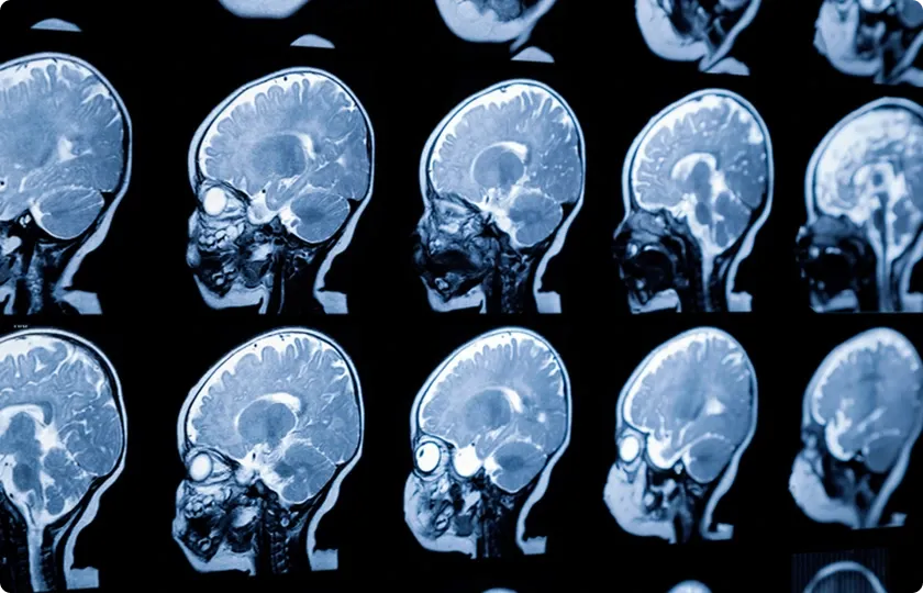 Canavan Diseases and Leukodystrophies | IDR Insights Driven Research | IDR